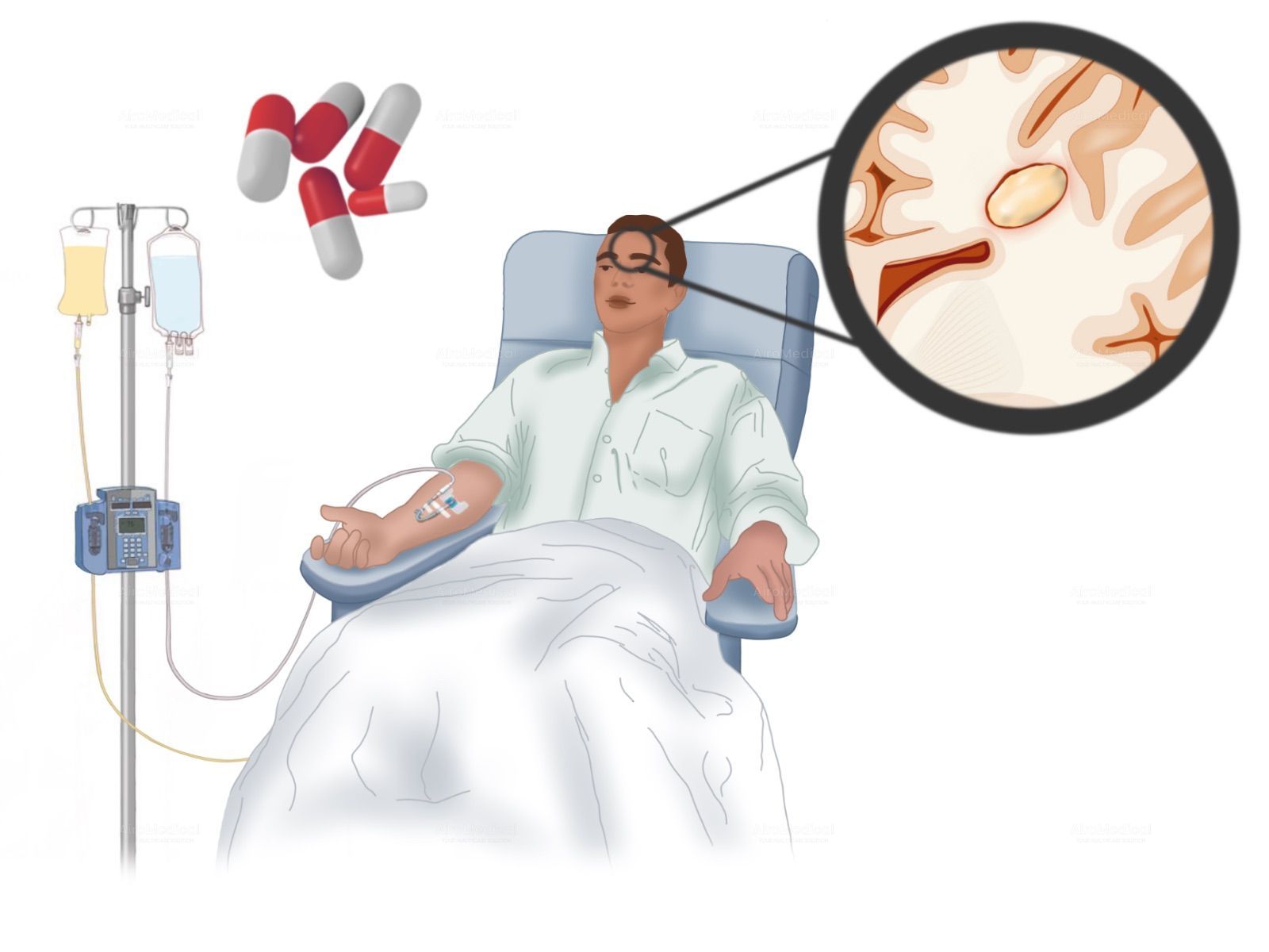 Brain abscess treatment with conservative medications