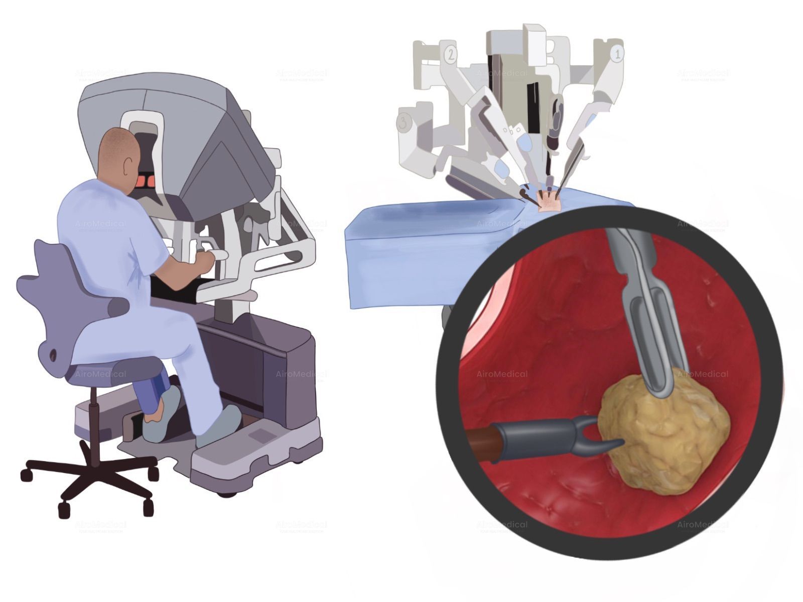Stomach cancer treatment with robotic-assisted stomach surgery