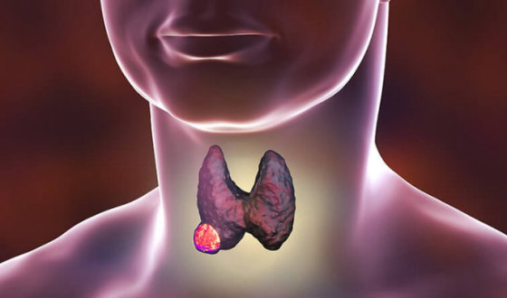 Thyroid Cancer: Symptoms, Diagnosis and Treatment